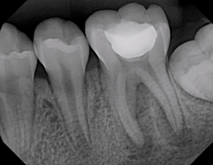 Digital X-rays - Signature Endodontics | Endodontist Saint Clair Shores, MI